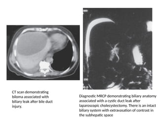 1.approach of Obstructive jaundice .pptx