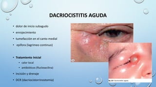 Enfermedades del Sistema Lagrimal | PPTX