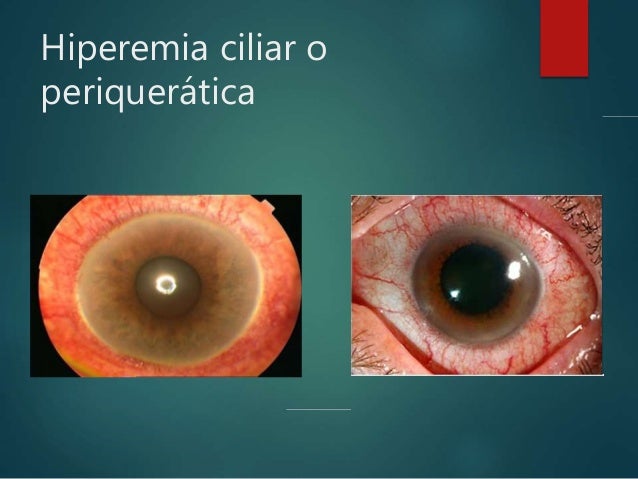 Ojo final