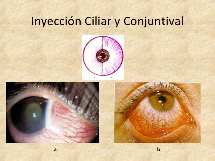 Ojo rojo