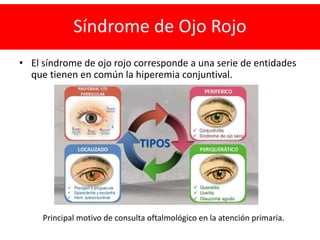 Surmedikal Oxigenoterapia CONJUNTIVITIS CAUSAS Y SINTOMAS, 44% OFF