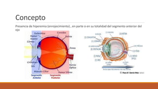 Ojo rojo | PPTX