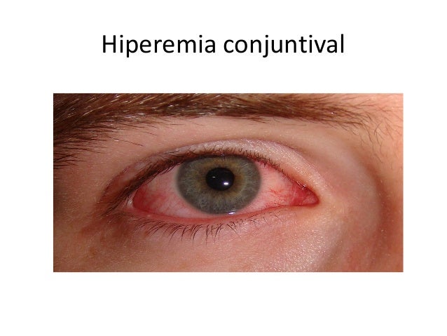 Ojo rojo