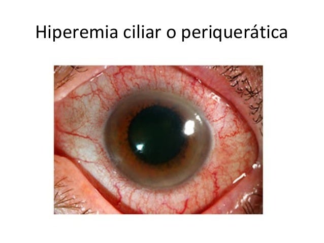 Ojo rojo
