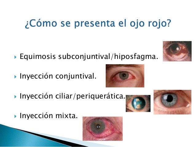 Mi paciente consulta por... Ojo rojo