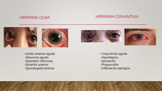Ojo rojo casos clínicos | PPTX