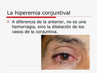 Ojo Rojo (Enfermería) | PPT