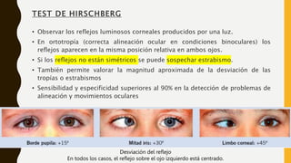 Ojo vago en pediatría/ambliopia ped.pptx