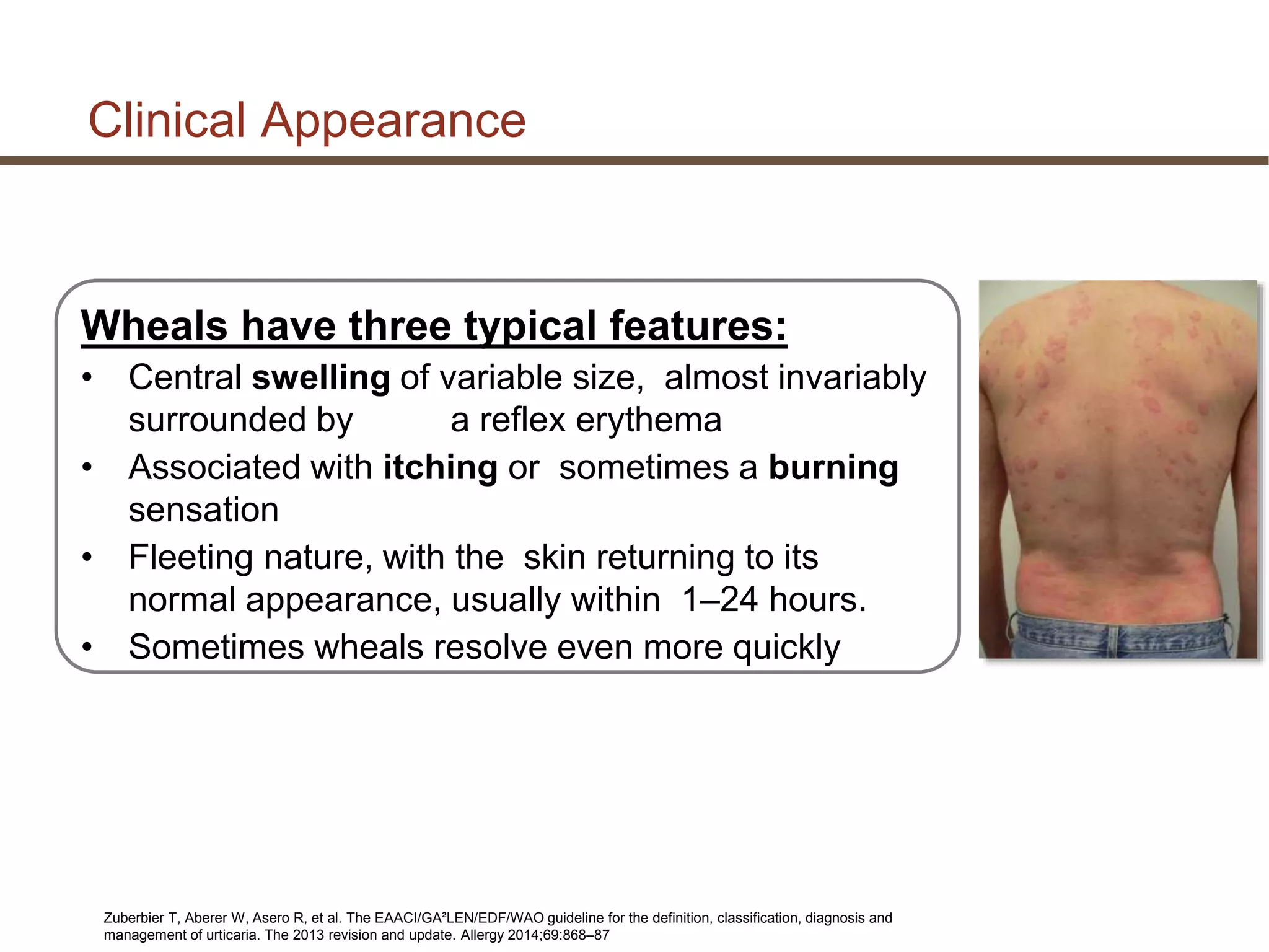 chronic urticaria | PPTX