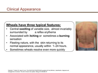 chronic urticaria | PPTX