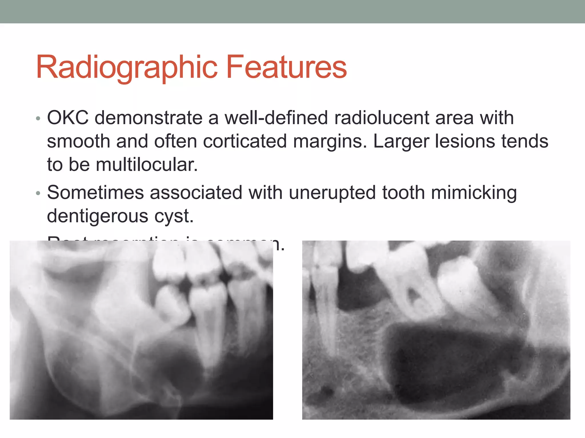 Odontogenic keratocyst- A case presentation | PPTX