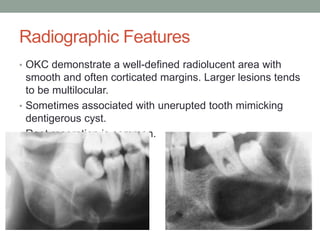 Odontogenic keratocyst- A case presentation | PPTX