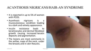 Acanthosis Nigricans Pcos