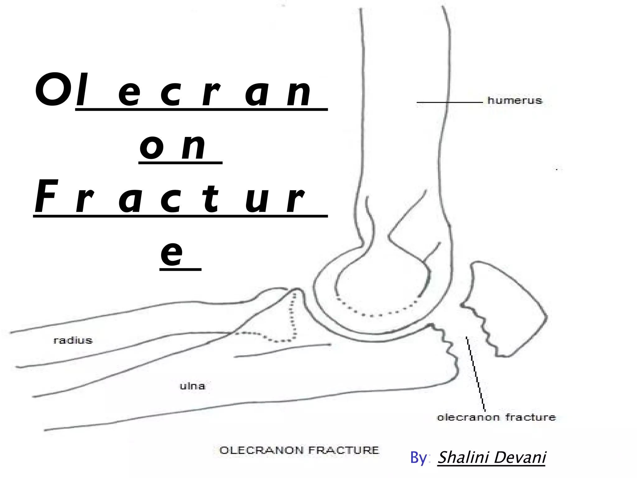 Olecranon fracture | PPT
