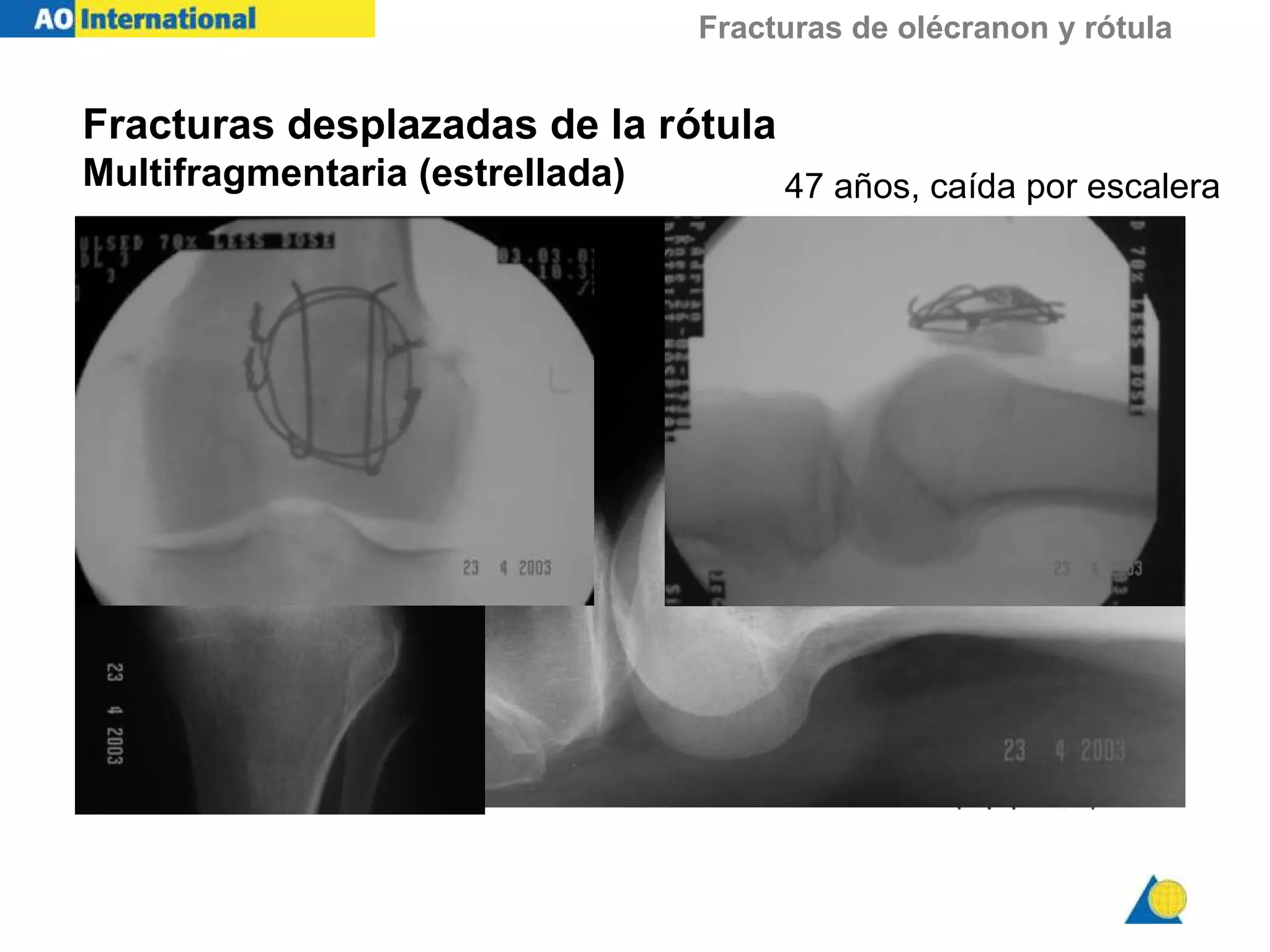 Olecranon rotula | PPT