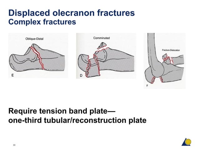 Olecranon fracture and patellar fractures.ppt