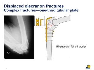 Olecranon fracture and patellar fractures.ppt