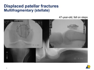Olecranon fracture and patellar fractures.ppt