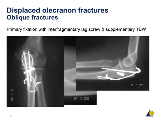 Olecranon fracture and patellar fractures.ppt