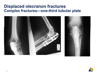 Olecranon fractures and patellar fractures.ppt