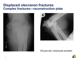 Olecranon fractures and patellar fractures.ppt