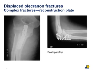 Olecranon fractures and patellar fractures.ppt