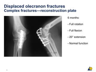 Olecranon fractures and patellar fractures.ppt