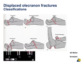 Olecranon fractures and patellar fractures.ppt