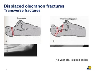Olecranon fractures and patellar fractures.ppt