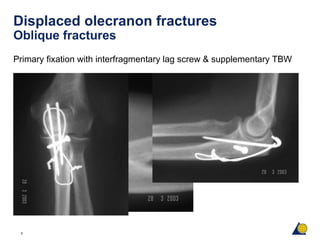 Olecranon fractures and patellar fractures.ppt