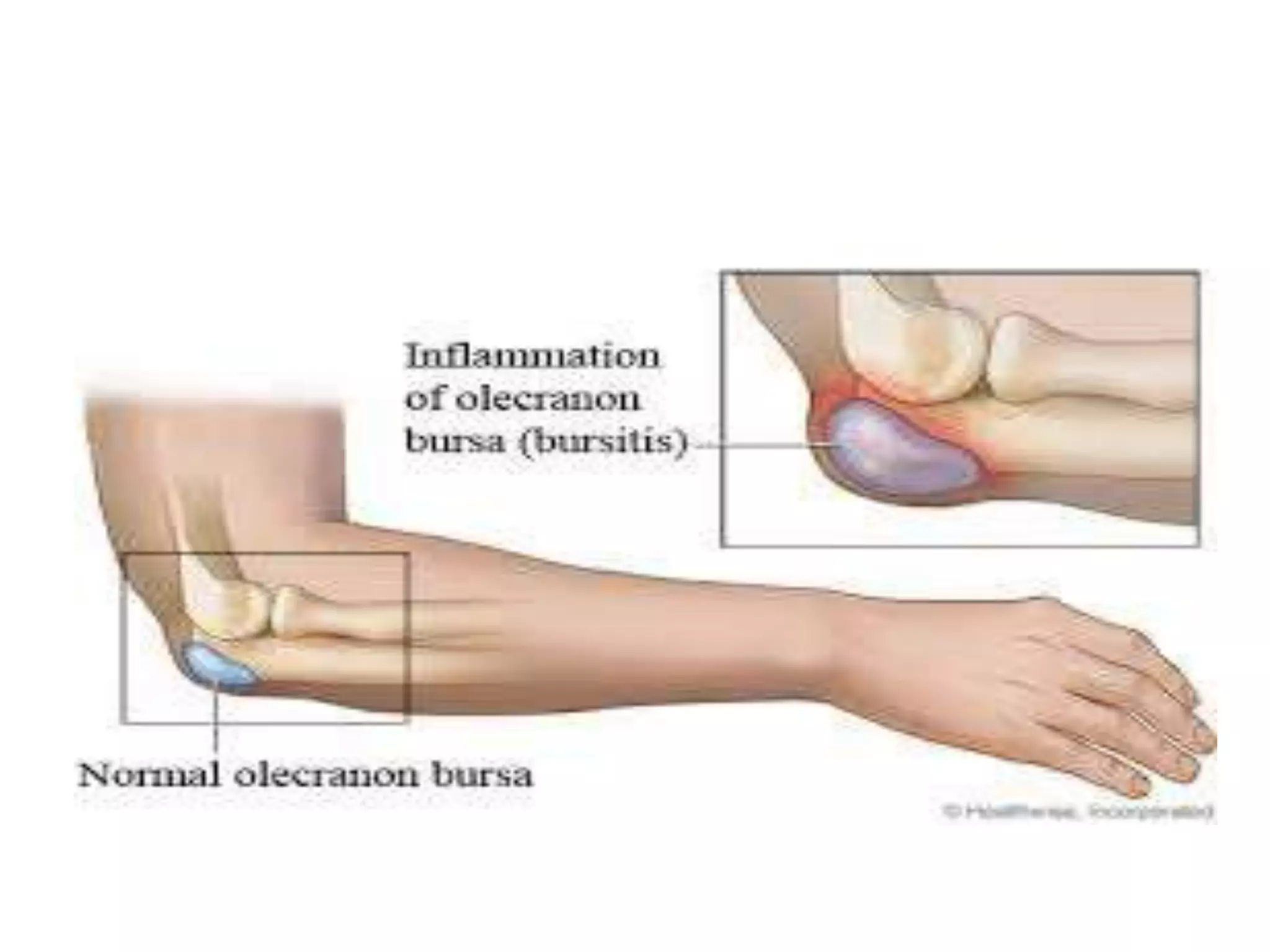 Olecranon bursitis | PPTX