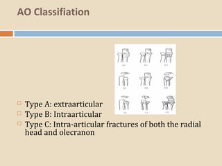Olecranon fracture | PPT