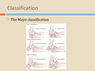 Olecranon fracture | PPT
