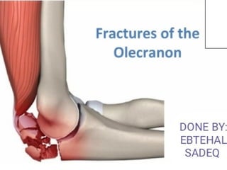 olecranon fracture, anatomy clinical picture.pptx