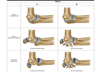 olecranon fracture, anatomy clinical picture.pptx