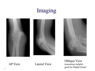 olecranon fracture, anatomy clinical picture.pptx
