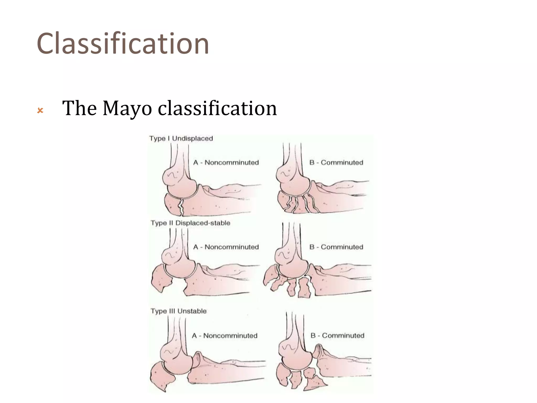 Olecranon fracture | PPTX