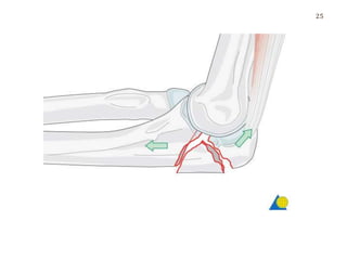 Olecranon fracture | PPTX
