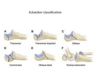 Olecranon fracture | PPTX