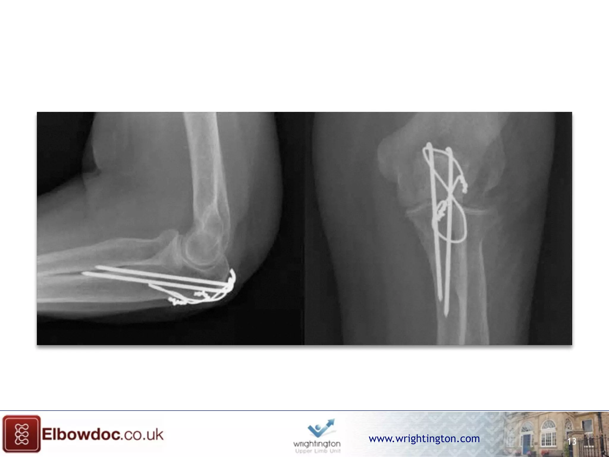 Proximal Ulna Fractures | PDF