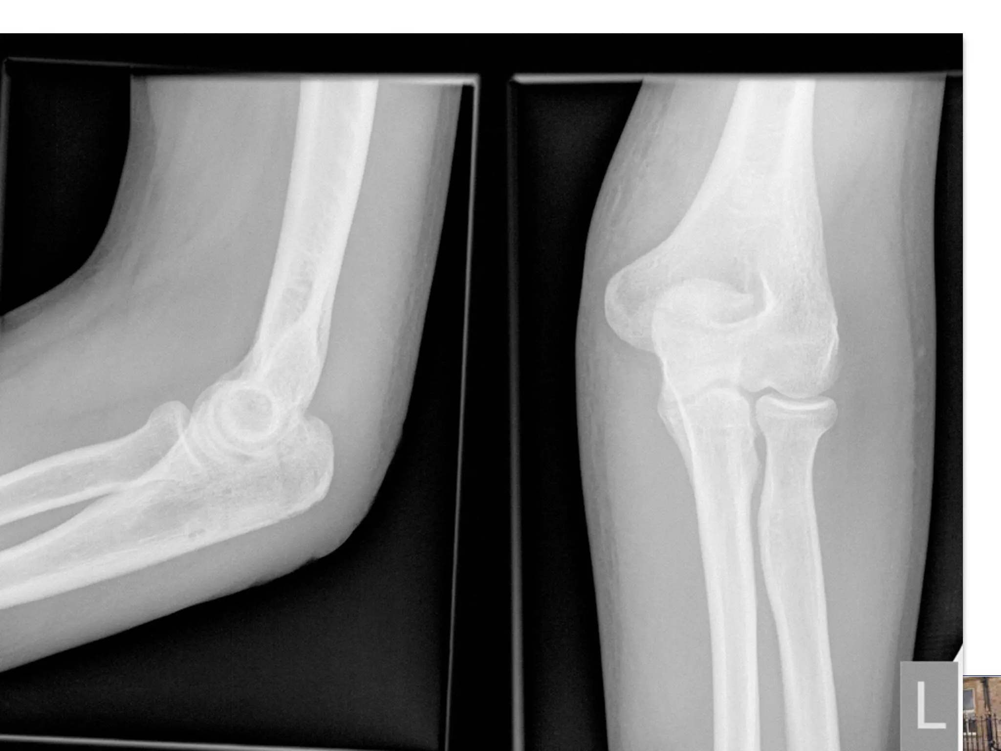 Proximal Ulna Fractures | PDF