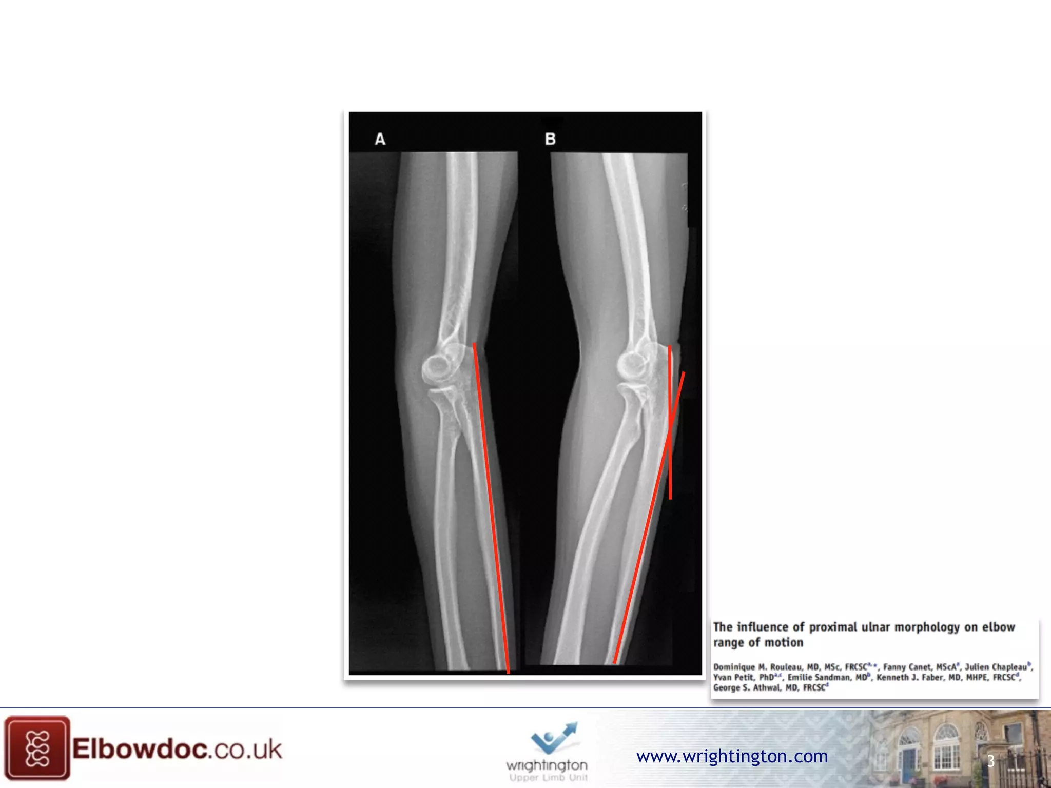 Proximal Ulna Fractures | PDF