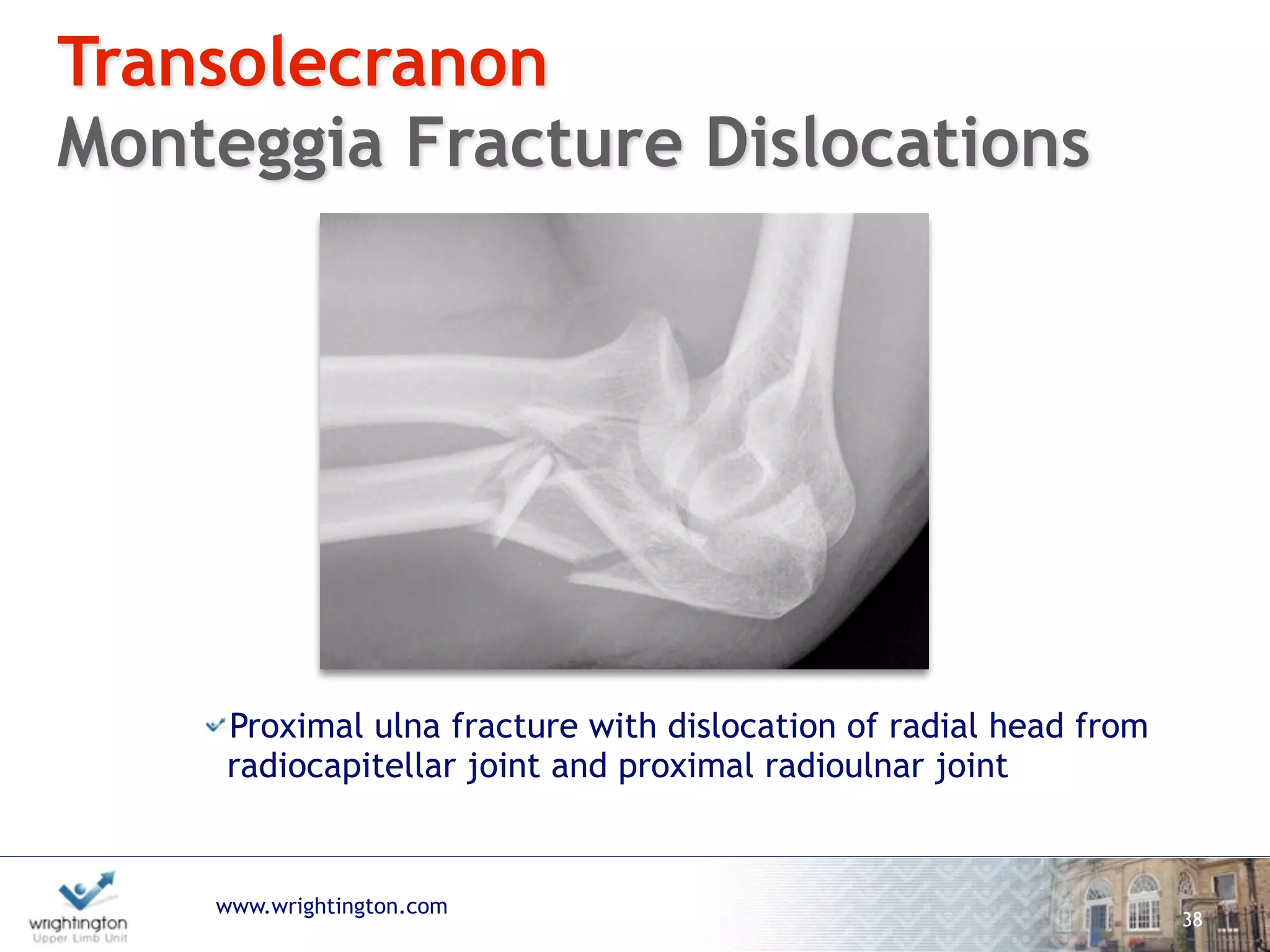 Proximal Ulna Fractures | PDF