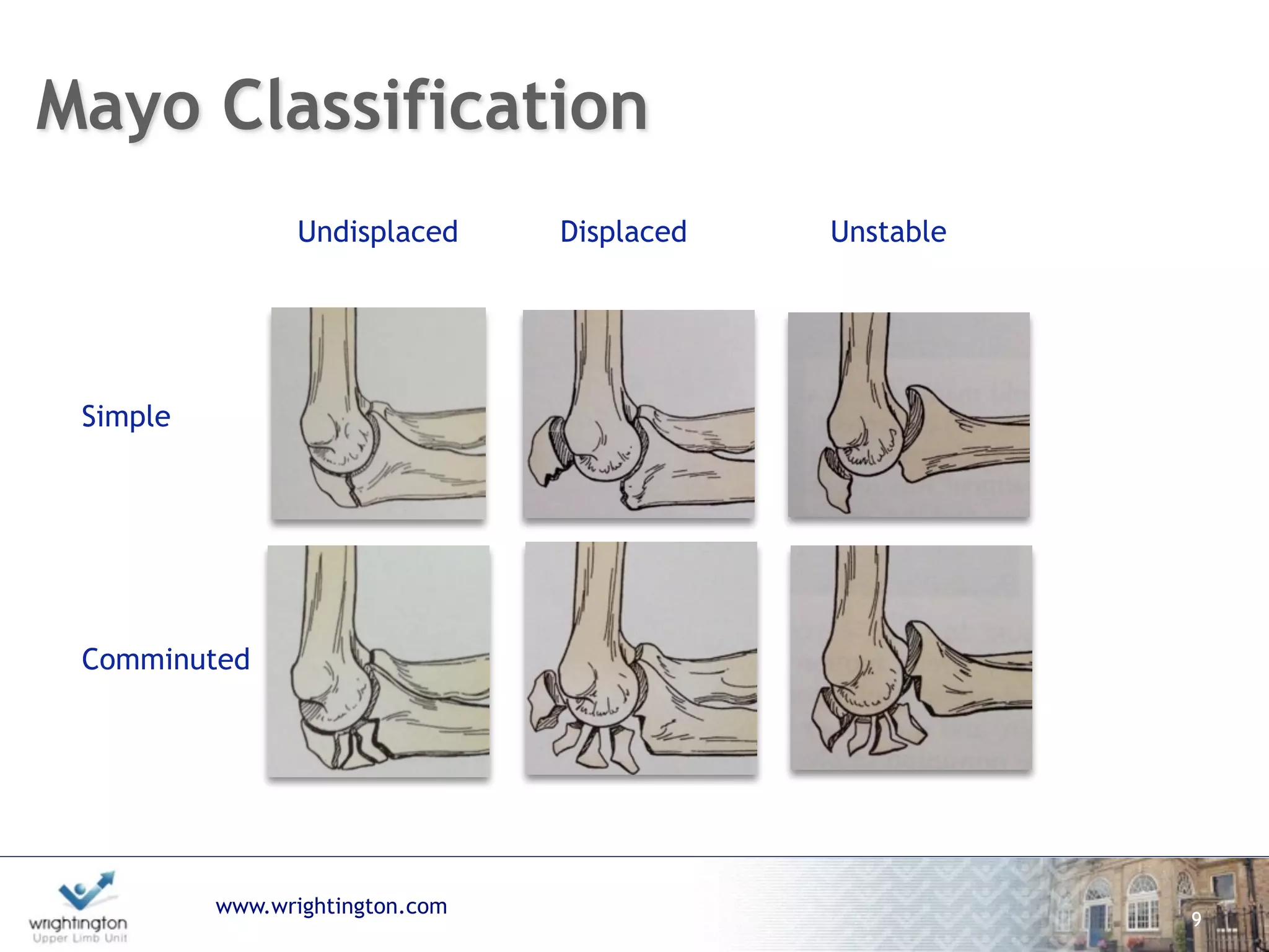 Proximal Ulna Fractures | PDF
