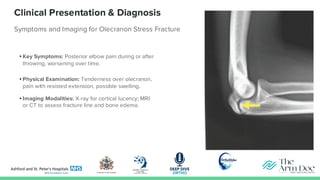 Olecranon Stress Fractures presentations and treatment options | PDF