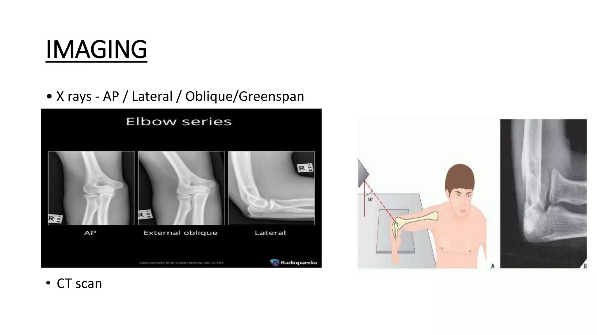 Olecronon and radial head fractures (1).pptx