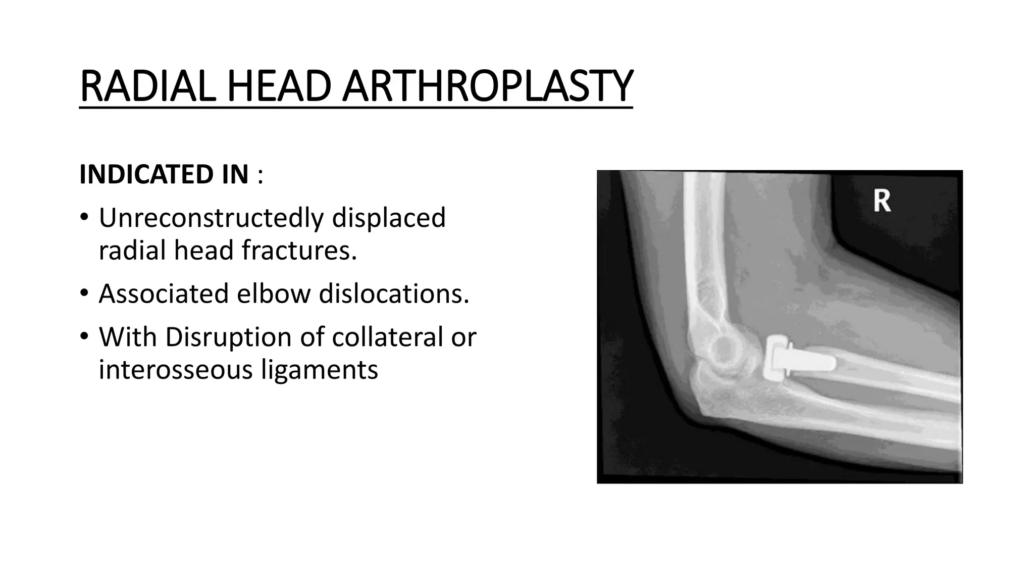 Olecronon and radial head fractures (1).pptx