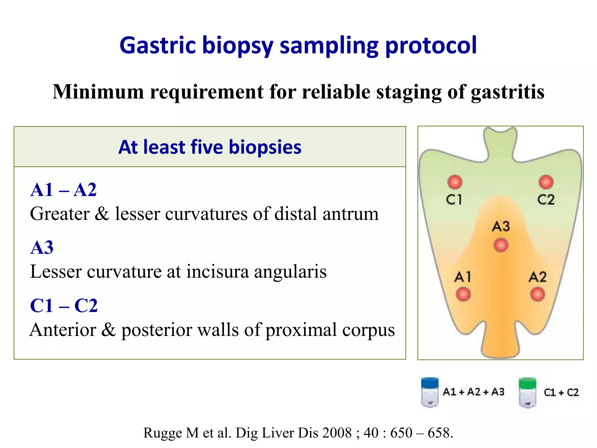 Olga staging system for diagnosis of gastritis | PPTX