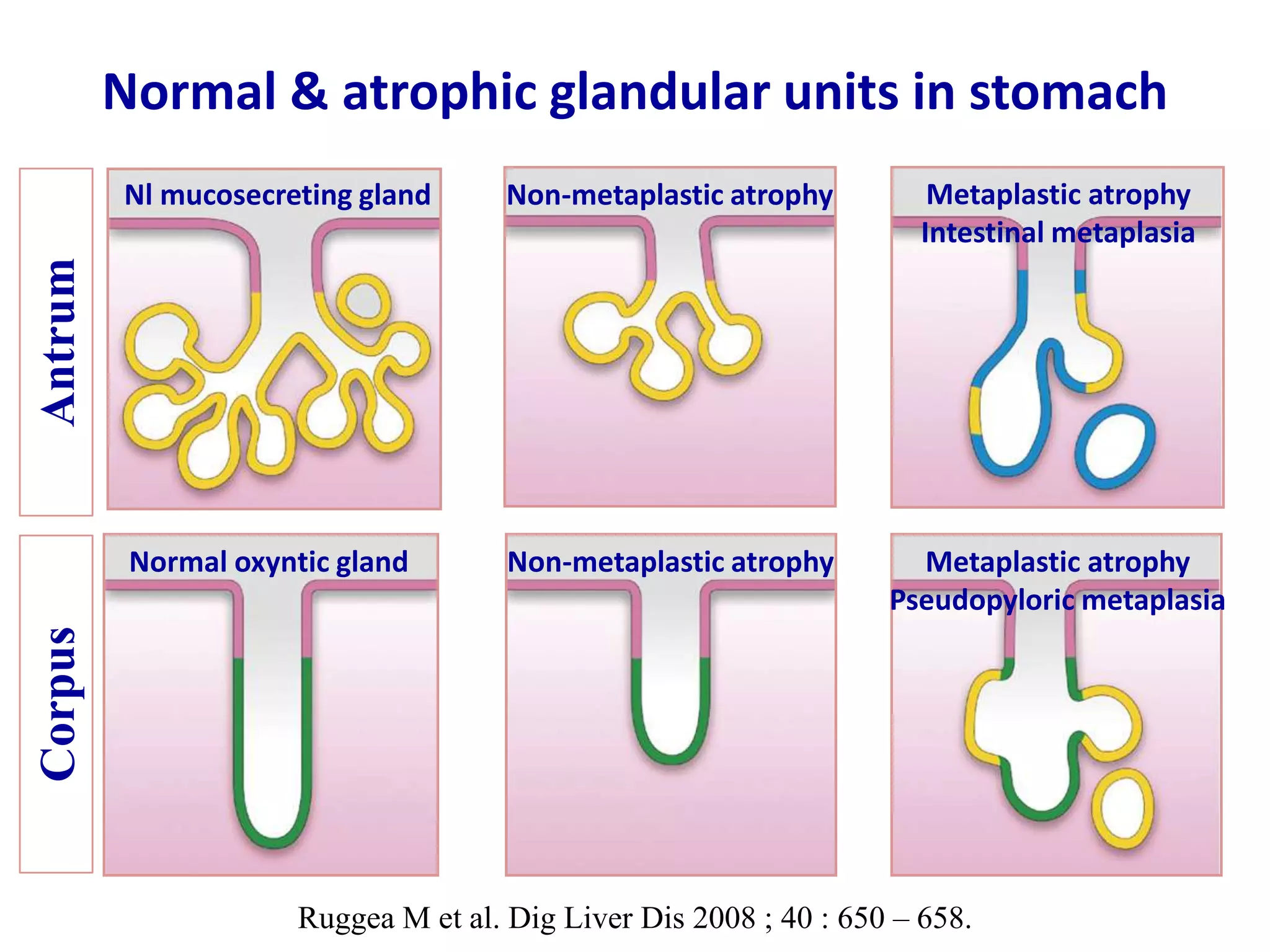 Olga staging system for diagnosis of gastritis | PPTX