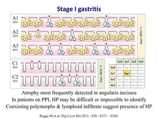 Olga staging system for diagnosis of gastritis | PPTX